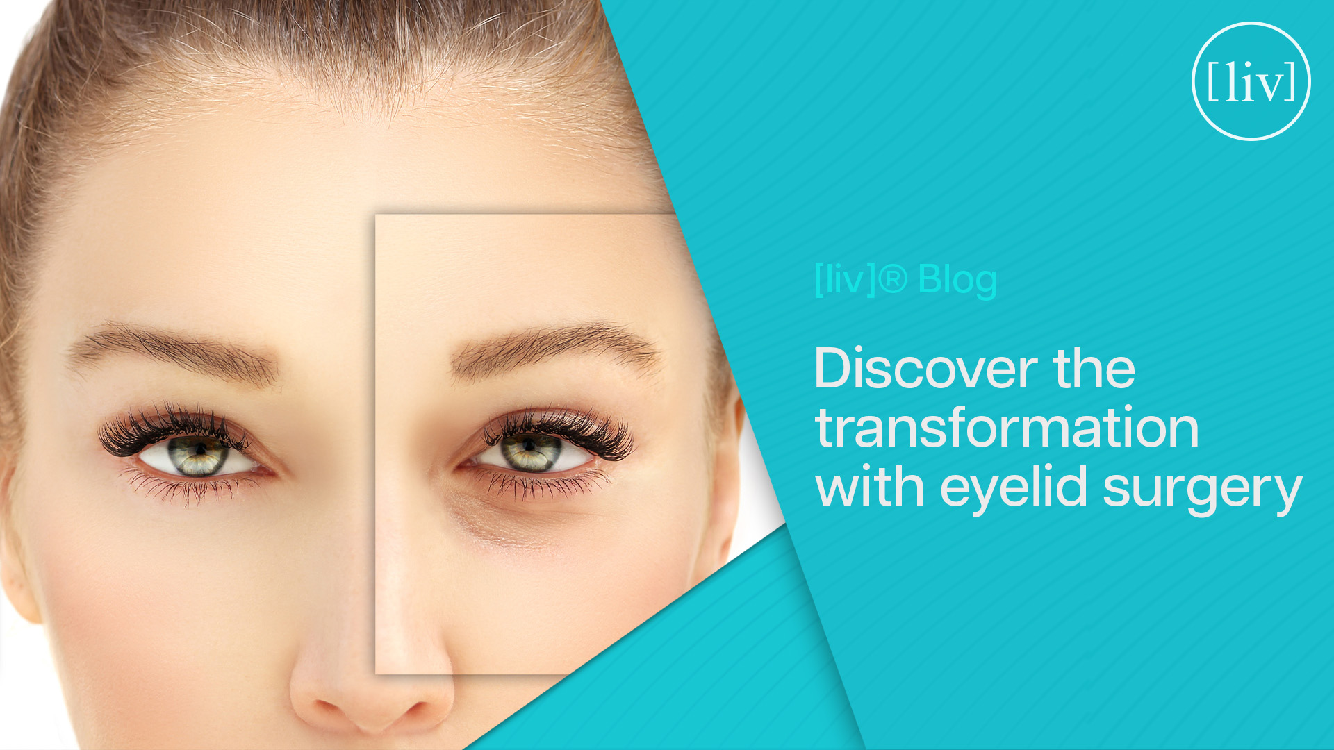 Double Blepharoplasty Before After Photos Double Eyelid Surgery Results